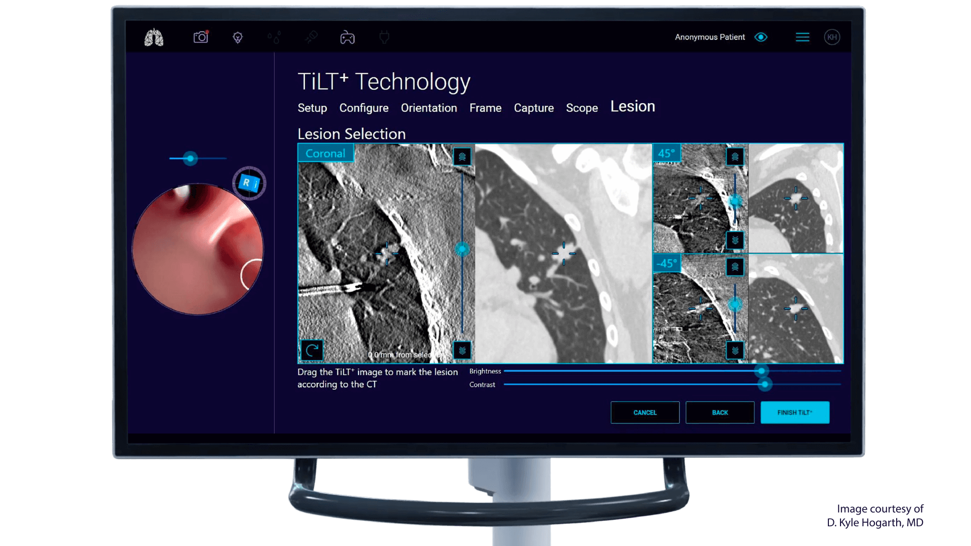 Tool in lesion technology - TiLT + Technology